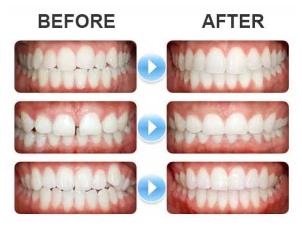 Braces & ClearCorrect Aligners - Oral Square Dental Care